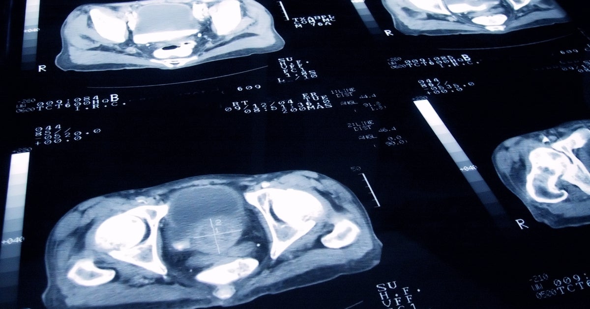 Wait-and-watch approach may be safe for some men with prostate cancer ...