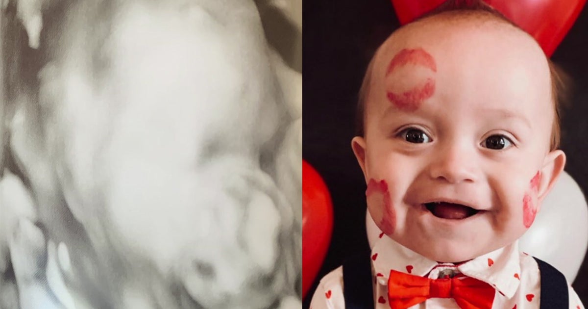 The Miracle Of Baby Jagger: Boy Celebrates 1st Birthday After Removal ...