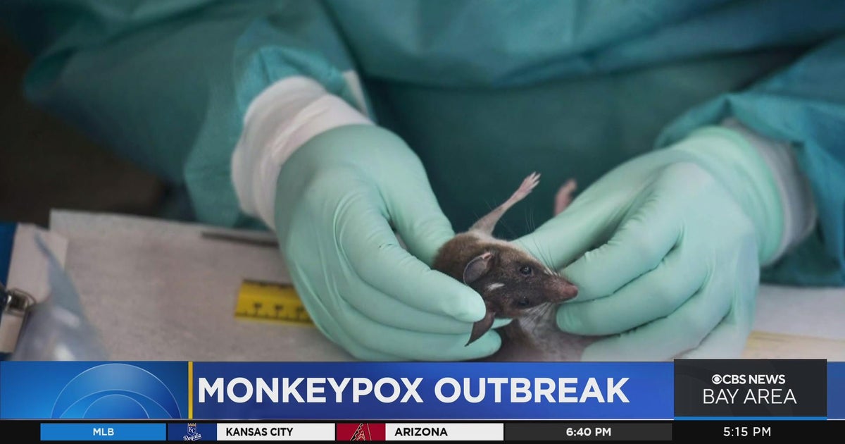 Local health experts weigh in on worldwide Monkeypox outbreak - CBS San ...