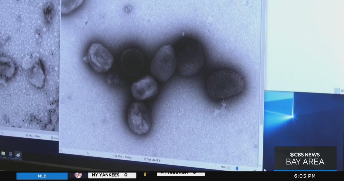 Rising monkeypox cases in Bay Area raise concern among health officials ...