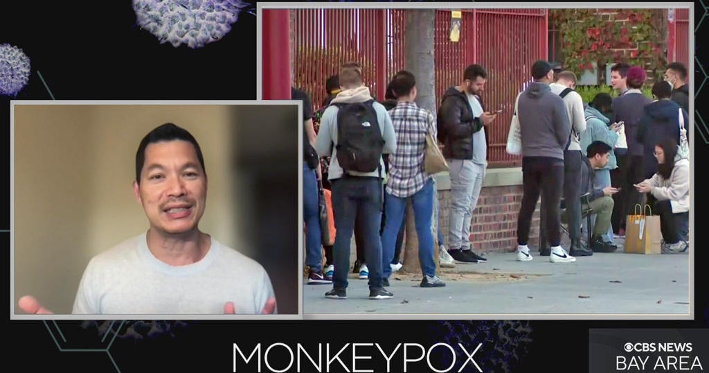 Talking Monkeypox: Dr. Peter Chin-Hong - CBS San Francisco