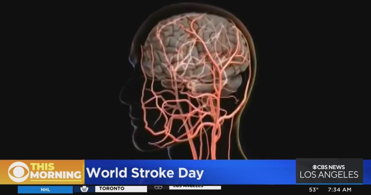 World Stroke Day: Signs to look for - CBS Los Angeles