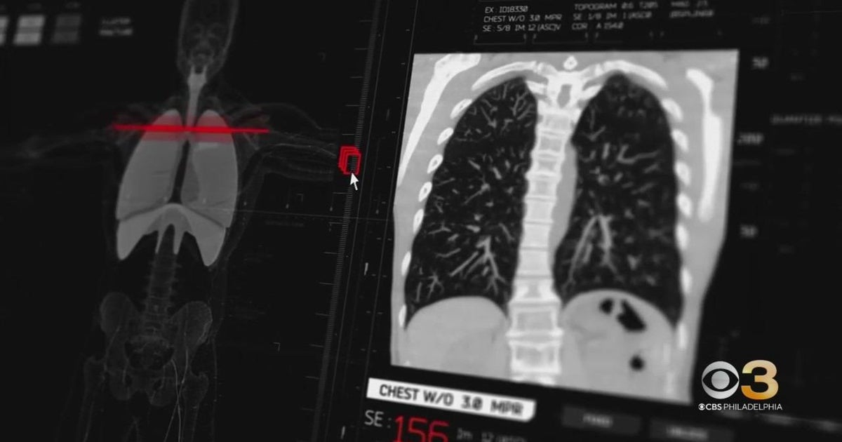 New robotic technology helping to find, treat lung cancer - CBS ...