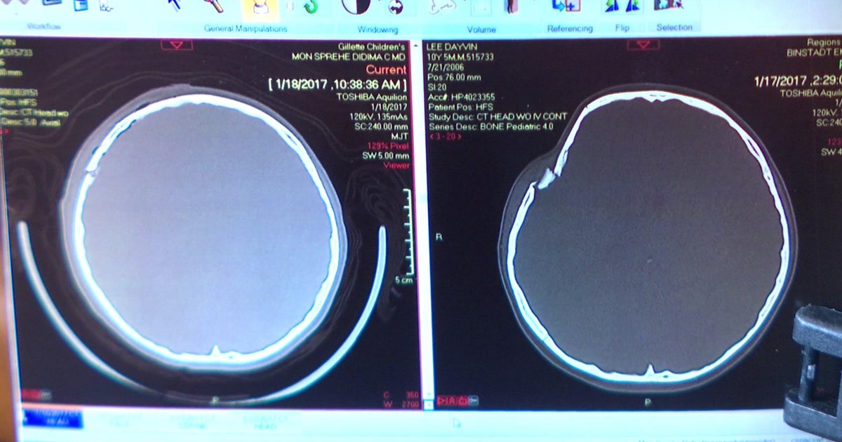 "It changed my life forever": Helmets urged for sledding to prevent ...