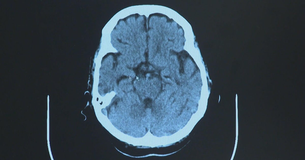 New study reveals people with autism are more sensitive to pain - CBS ...