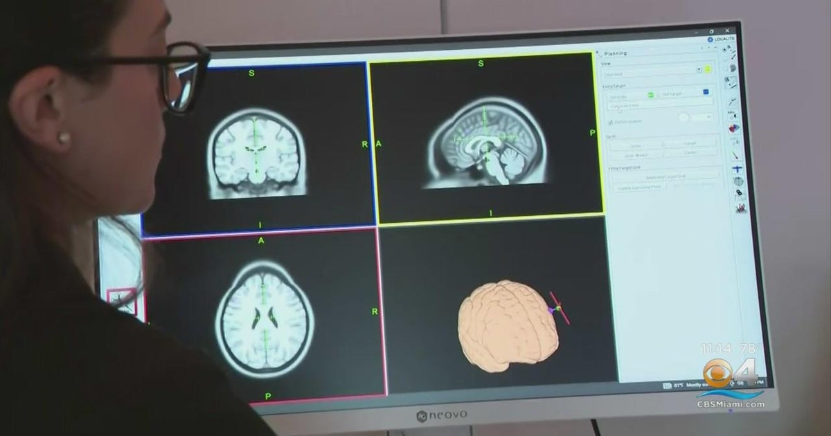 Transcranial magnetic stimulation therapy offers relief for some ... Transcranial magnetic stimulation therapy offers relief for some ...
