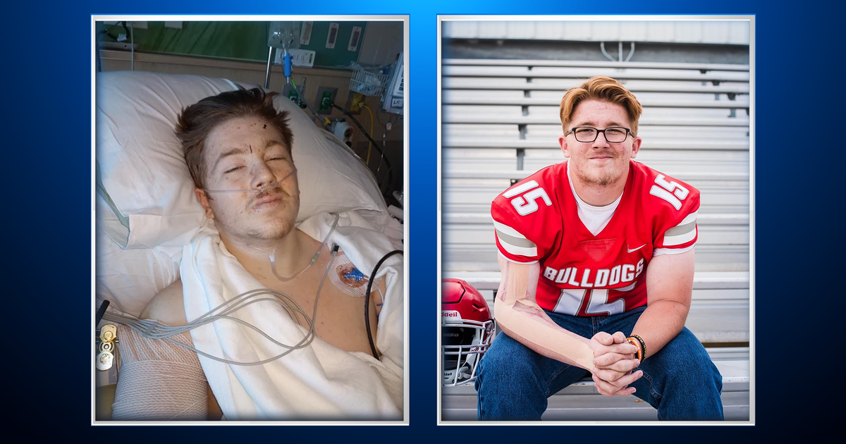 Colorado teen who nearly lost arm after crash hopes to inspire others ...
