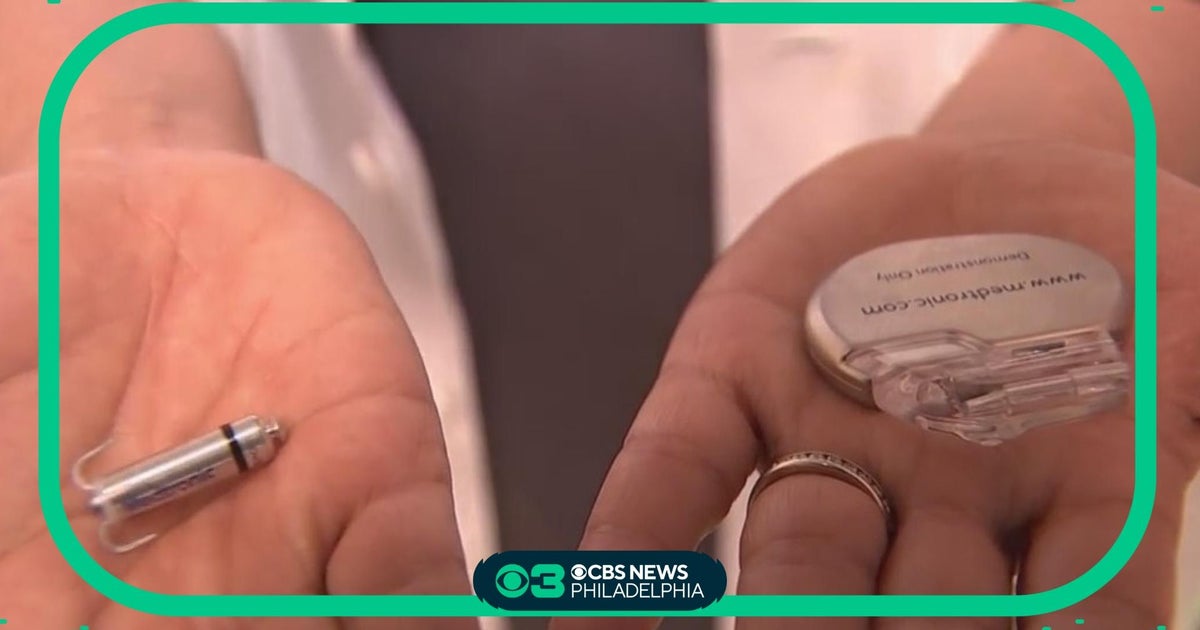 Baby recovering after receiving smallest pacemaker in the world - CBS ...