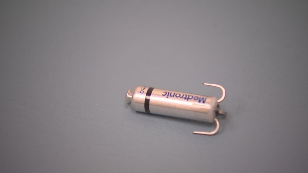 Philadelphia baby receives world's smallest pacemaker - CBS Philadelphia