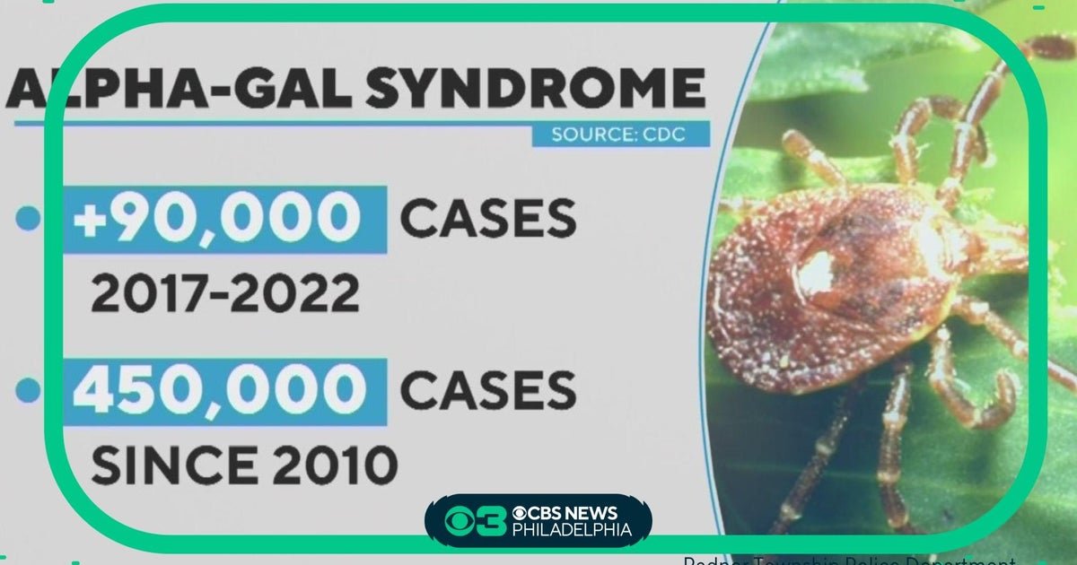 Up to 450,000 in U.S. have red meat allergies due to alpha-gal syndrome ... Up to 450,000 in U.S. have red meat allergies due to alpha-gal syndrome ...