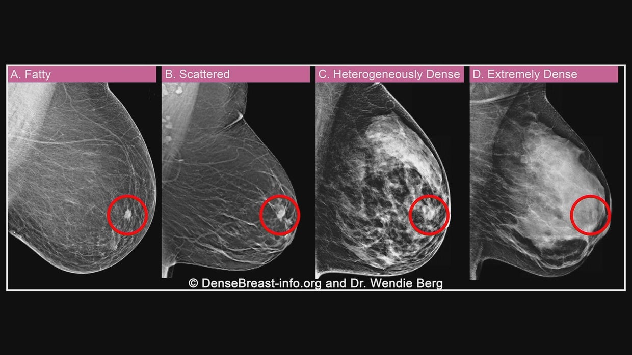 Breast cancer survivor fights for laws to increase breast density ...