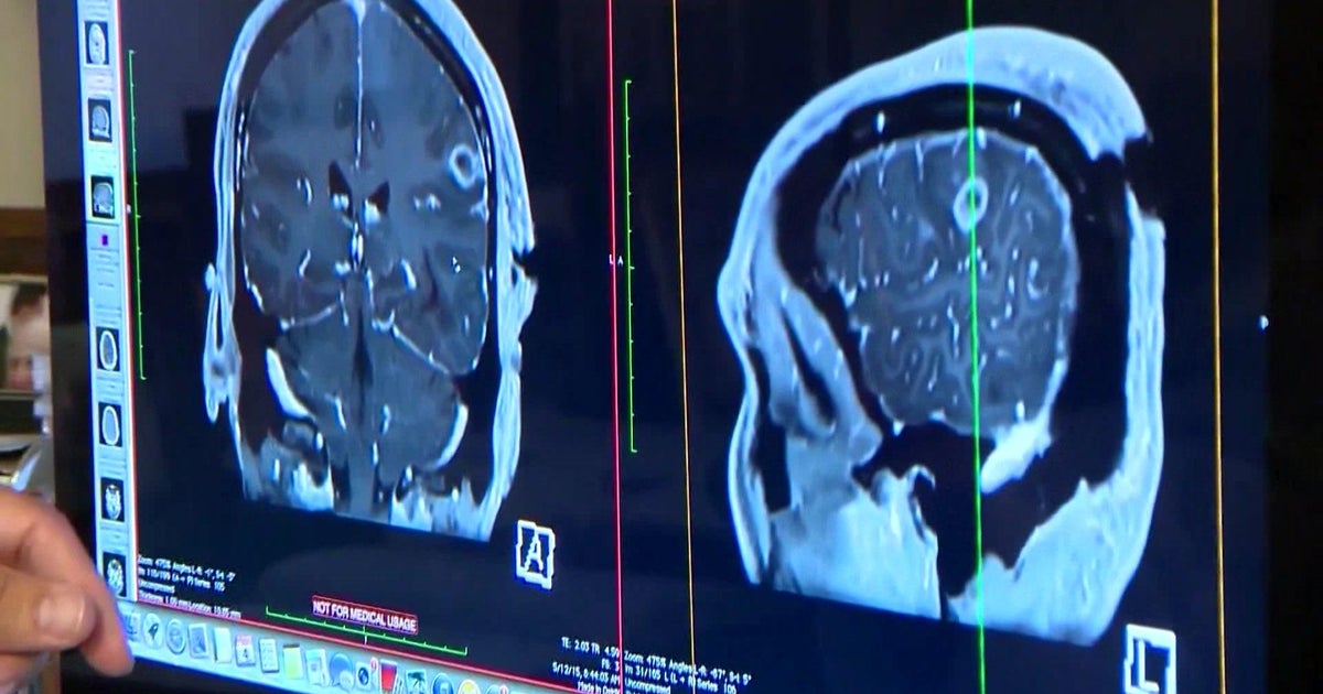 Massachusetts researchers find memory loss may predict brain changes ...