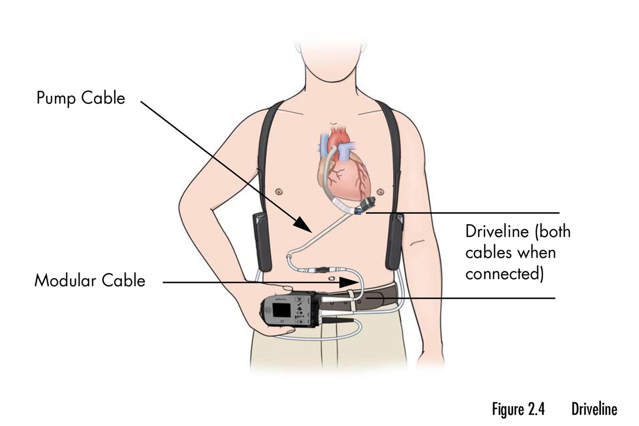 Lvad Heartmate Ii LVAD — Taming The SRU
