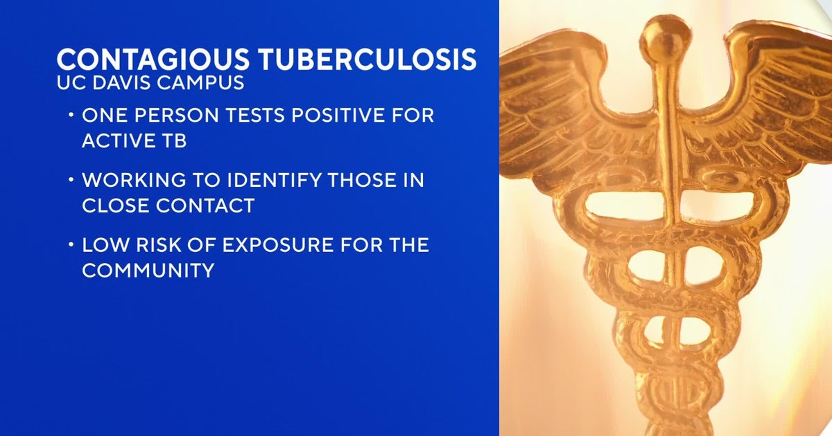 Person with contagious tuberculosis identified at UC Davis - CBS Sacramento