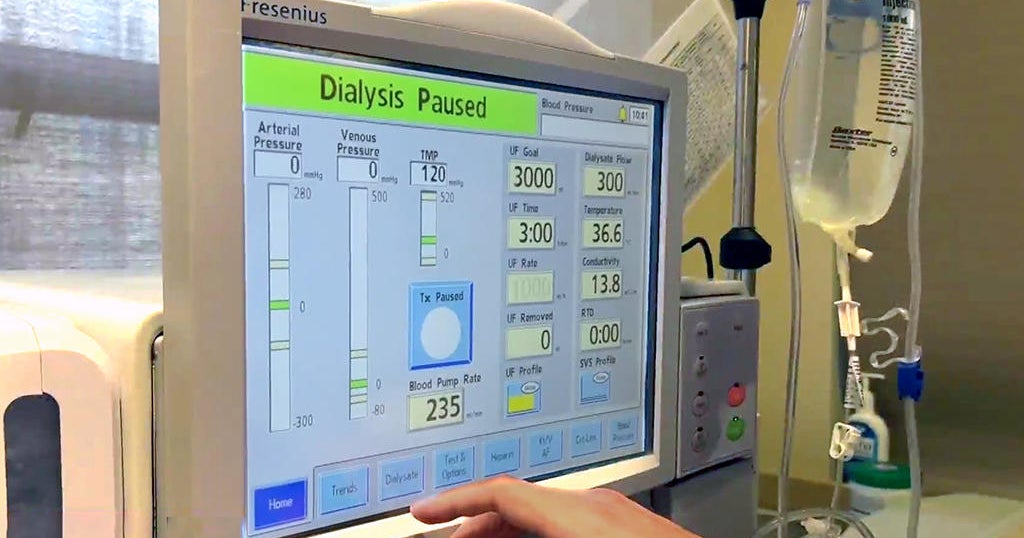 UCSF study finds some with kidney disease may not need dialysis - CBS ...