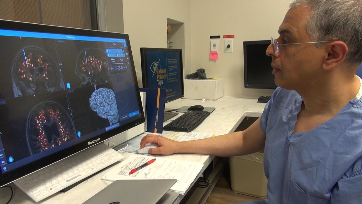 Neurosurgeon works to slow Alzheimer's progression, treat addiction ...