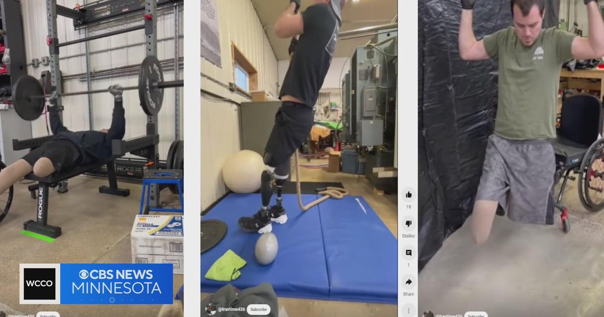 Minnesotan walks again after losing legs in farm accident - CBS Minnesota