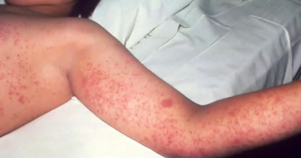 Bay Area health officials warn of measles uptick, recommend vaccination ...