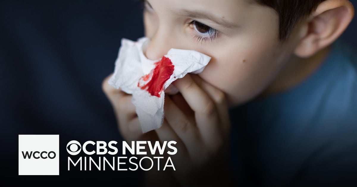 Kids' nosebleeds: What parents need to know - CBS Minnesota