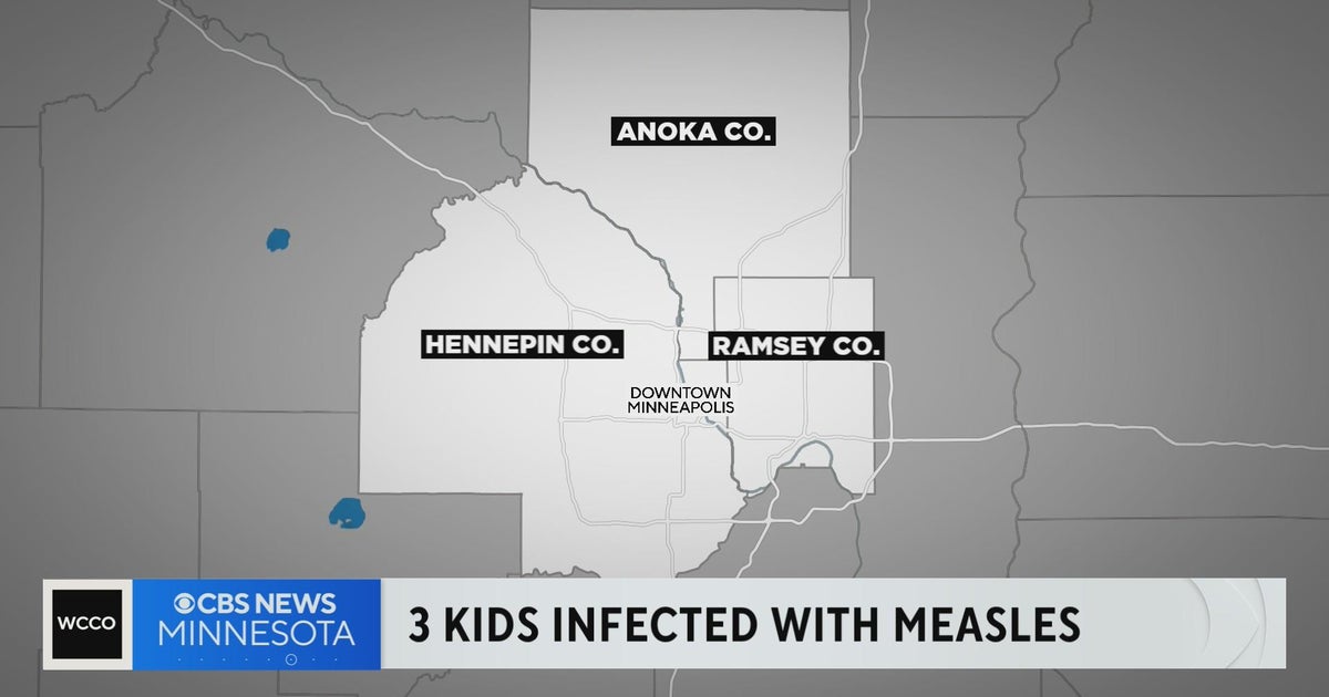 3 cases of measles confirmed in Twin Cities - CBS Minnesota