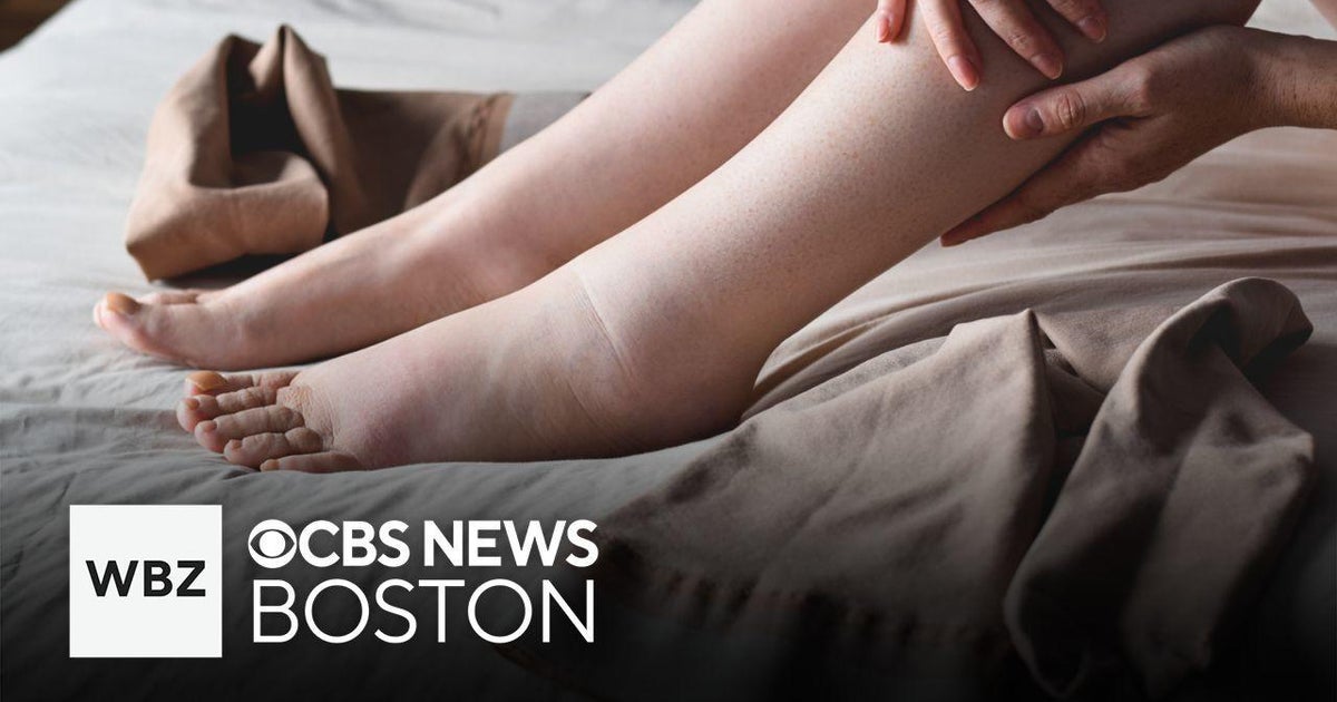 How do I treat lymphedema in my legs? Dr. Mallika Marshall answers your ...