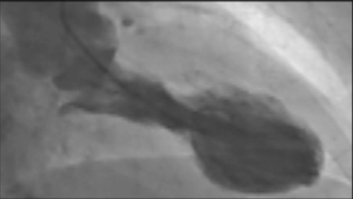 What is "broken heart syndrome"? How heartbreak can change the ...