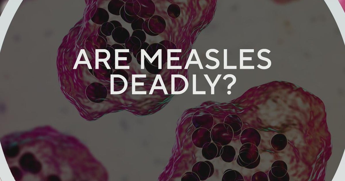 Infectious disease doctor answers measles FAQs - CBS Texas