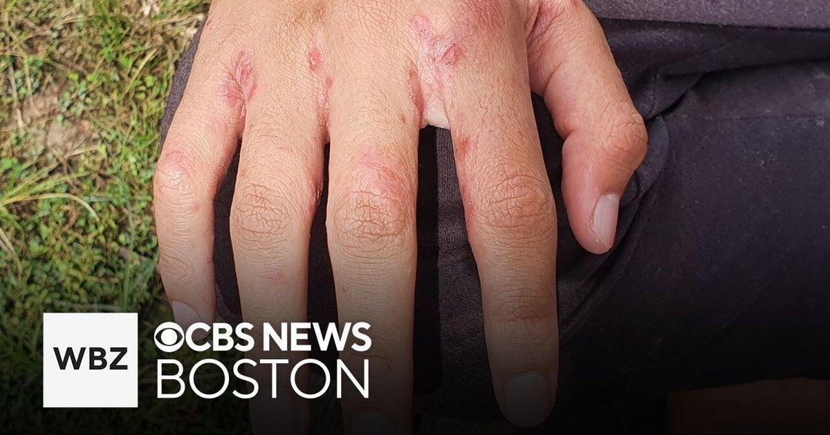 What are scabies and how can they be treated? - CBS Boston