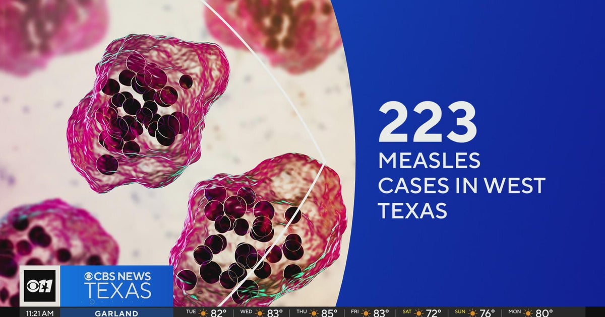 Texas measles cases rise to 223 - CBS Texas