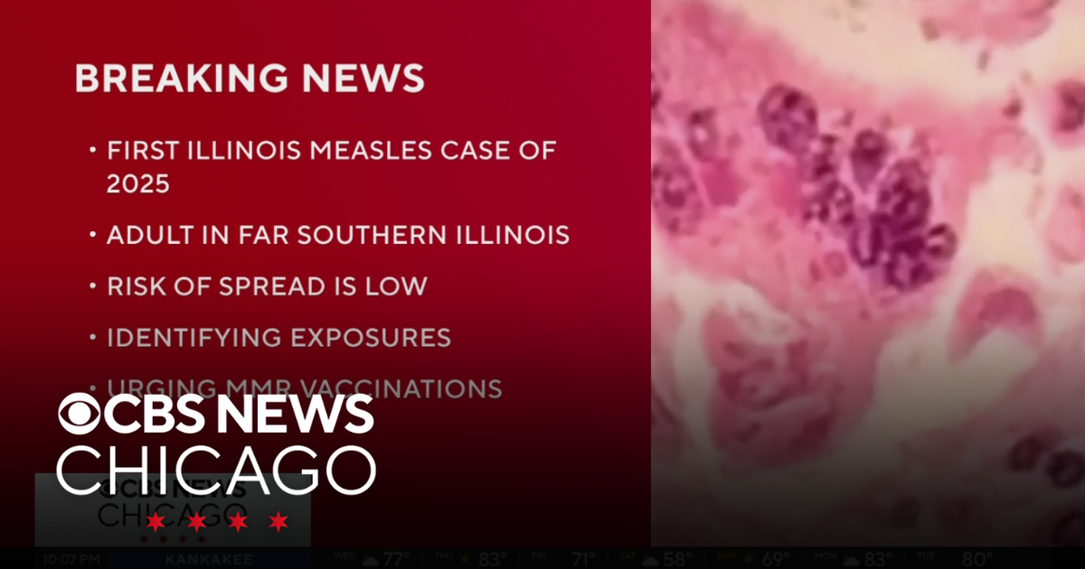 First Illinois case reported in 2025 measles outbreak - CBS Chicago