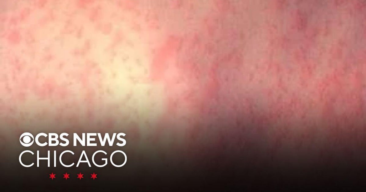 2 measles cases confirmed in Cook County - CBS Chicago