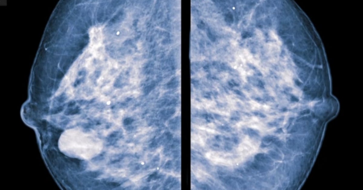 Contrast-enhanced mammography can identify 3x as many tumors in dense ...