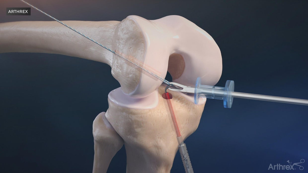 After tearing his ACL, a Pennsylvania high school athlete received a ...