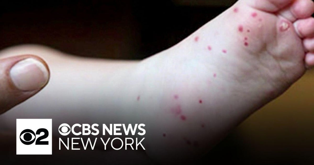 Hand, foot and mouth disease cases on the rise ahead of new school year ...