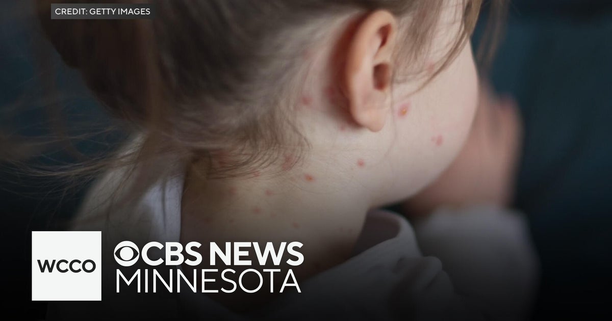 More measles cases reported in Minnesota - CBS Minnesota