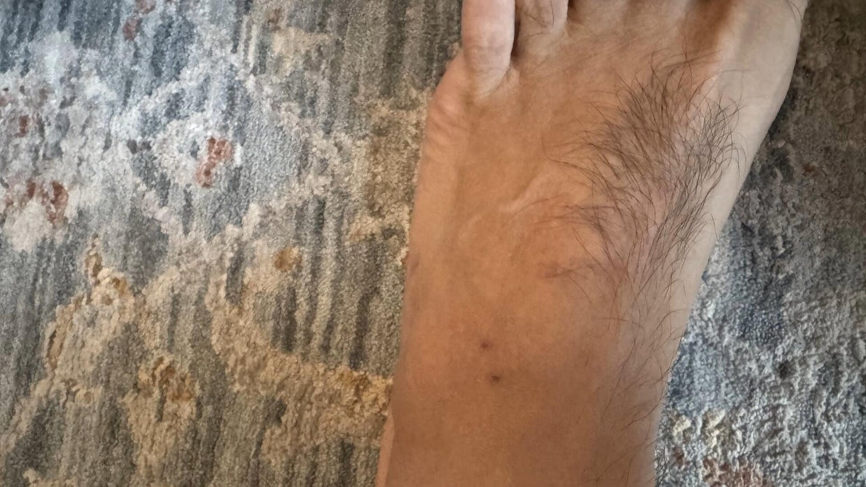 Denver hotel guest says he was bitten by bat while sleeping, has filed ...