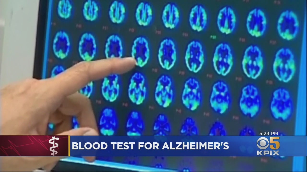 New Blood Test For Alzheimer s A Huge Breakthrough For Millions Of